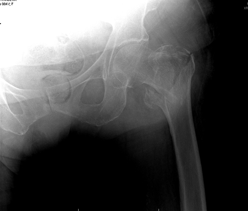 Intertrochanteric Fractures - Trauma - Orthobullets